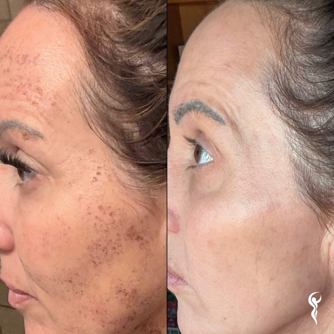 Forever Body BBL – Enhance Your Curves at Trilogy Medical Center